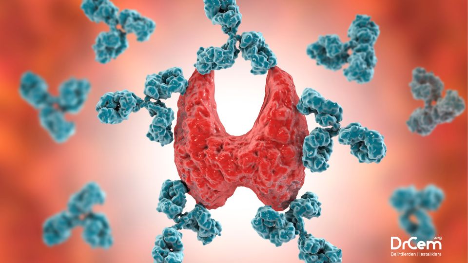 Hashimoto hastalığı Nedir ? Belirtileri, Nedenleri, Tedavisi - DRCem